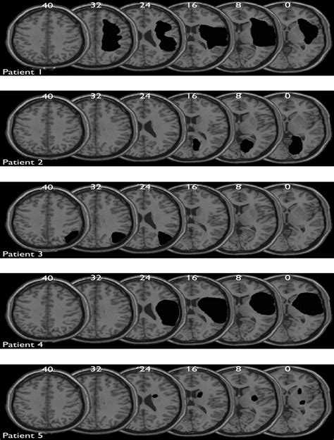 Prismatic Adaptation Reduces Biased Temporal Order Judgement Neuroreport