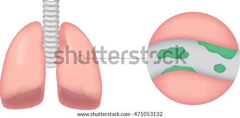 Bronchiectasis Diagram Stock Illustration 471053132 Shutterstock