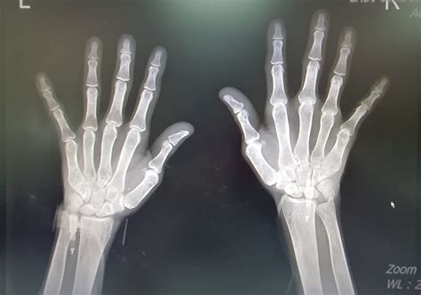 Med Film Hands มีลักษณะ Thin Cortex กับลักษณะ Widening Sausage Shaped Metacarpal Bones ถ้า