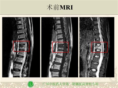 椎体成形中骨水泥充分填充的技巧及意义 好医术早读文章 好医术 赋能医生守护生命