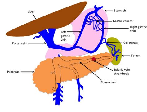 Variceal Bleed Antibiotics
