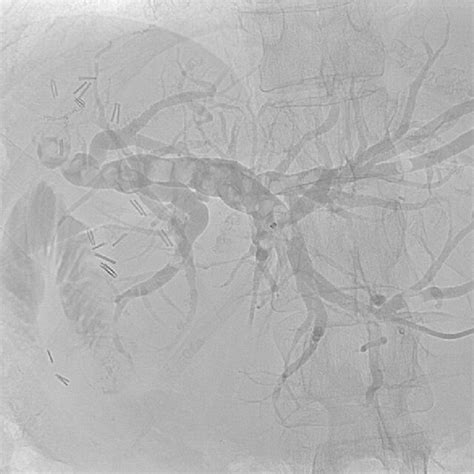 Percutaneous Transhepatic Cholangiography Shows Dilated Left Download Scientific Diagram