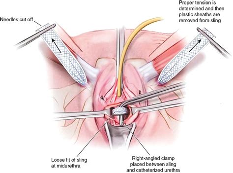 Synthetic Midurethral Slings For Stress Urinary Incontinence Clinical