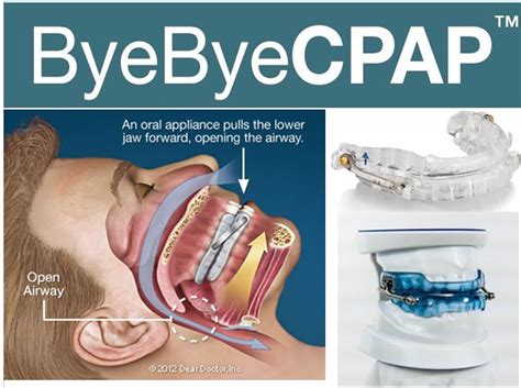 Oral Appliance Therapy For Obstructive Sleep Apnea Va Md And Dc