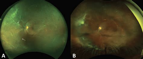 Managing Acute Retinal Necrosis