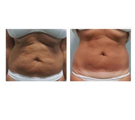 Pack Reductivo 12 Sesiones Abdomen Hera Laser