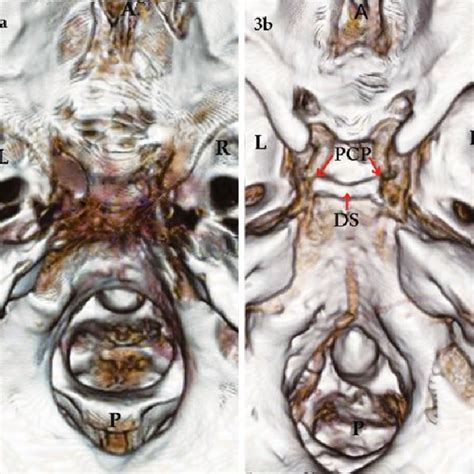 Distances Between The Posterior Clinoid Process And Relevant Skull Base
