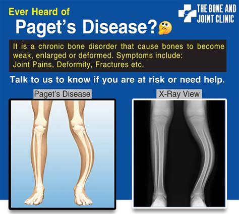 Pagets Disease The Bone And Joint Clinic