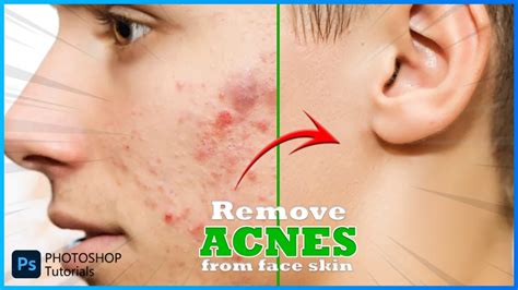 Realistic Way To Remove Acnes From Face Skin In Photoshop Quick And Easy Photoshop Youtube