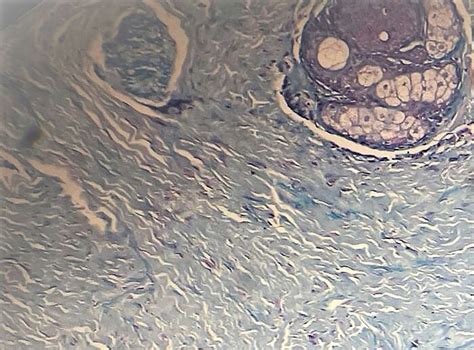 A Low Power 10× Lens Total Magnification 100× Mild Acanthosis
