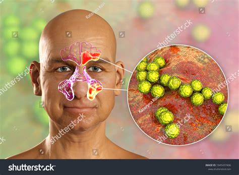 Streptococcus Pyogenes Bacteria Cause Sinusitis 3d Stock Illustration