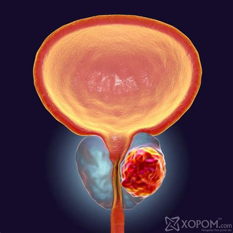 Түрүү булчирхайн хорт хавдрын эхэн үед илрэх 7 шинж тэмдэг Эдгээрийг