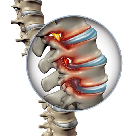 Best Spinal Decompression Ballina Non Surgical Disc Bulge Solutions