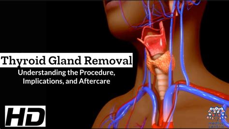 Thyroid Surgery Explained What They Dont Always Tell You Youtube