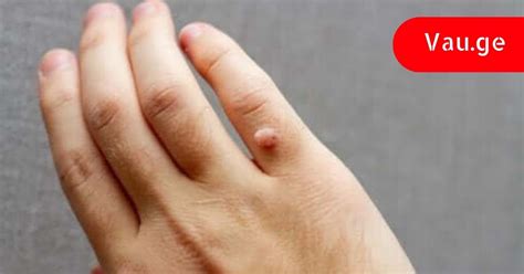 მე ამ მეთოდების გაოყენებით მოვიშორე მეჭეჭები სულ რაღაც ორ კვირაში თუ მეჭეჭები შენც გაწუხებს