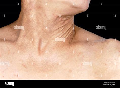 Pseudoxanthoma Elasticum Neck Of A Patient With Pseudoxanthoma Elasticum Pxe This Disease