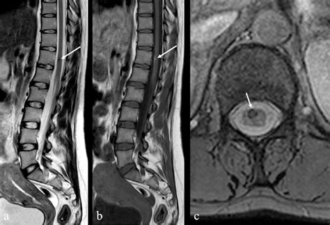 Spinal Cavernoma In A 22 Year Old Female Patient With Cerebral Download Scientific Diagram