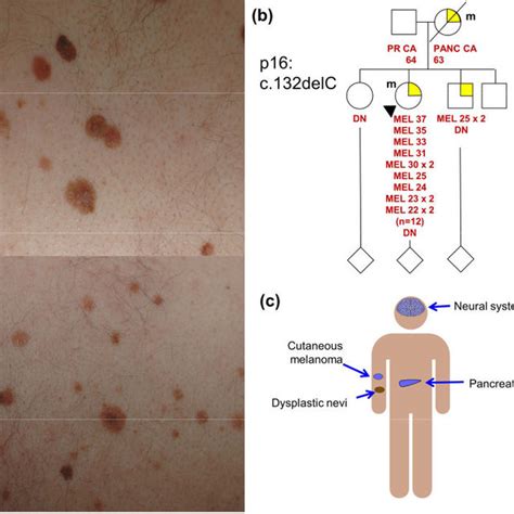 Pdf Hereditary Melanoma Update On Syndromes And Management