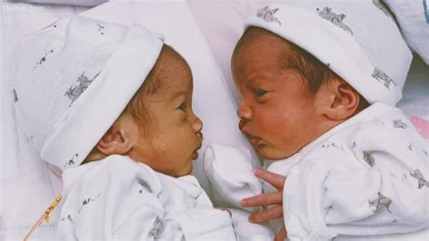 What Are Monochorionic Diamniotic Twins Mcda Is Normal Delivery Possible In Such A Case