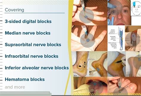 Accurate Block Placement