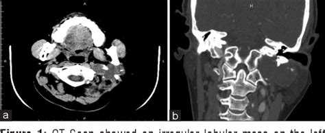 Figure 1 From Extraskeletal Myxoid Chondrosarcoma Of The Parotid Gland Semantic Scholar