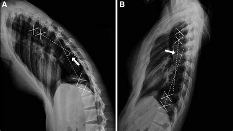 Measurement Of Thoracic Spine Range Of Motion Arrows Point To The Download Scientific Diagram