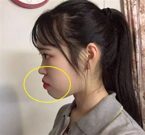 矫正牙齿对凸嘴改善大吗 知乎