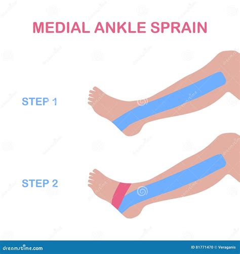Medial Ankle Sprain