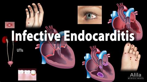Infective Endocarditis Animation Youtube