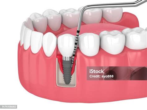 임플란트 주위염 질환 및 치주 Sonda가있는 인간 턱의 3d 렌더링 임플란트에 대한 스톡 사진 및 기타 이미지 임플란트 손실 치아 건강 Istock