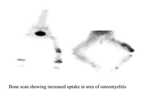 Osteomyelitis Pptx