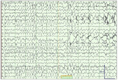 Continuous Electroencephalographic Eeg Monitoring Is An Effective Download Scientific Diagram