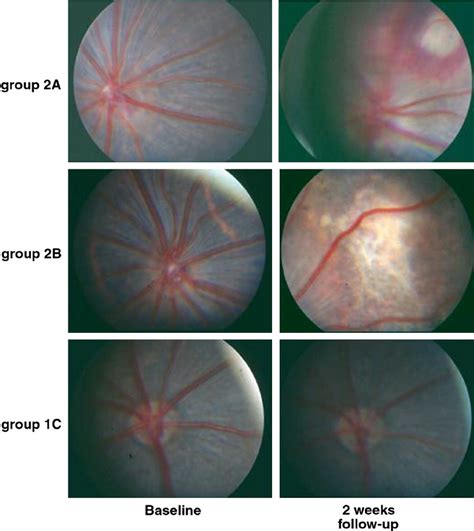 Fundus Photography Results Group 2a Hypopigmentation Area Surrounded