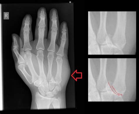Metacarpal Fractures WikiMSK