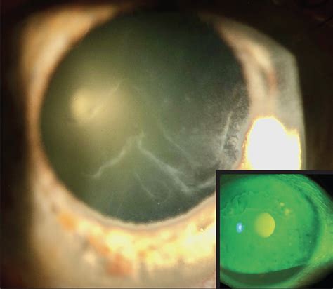 Map Dot Fingerprint Dystrophy
