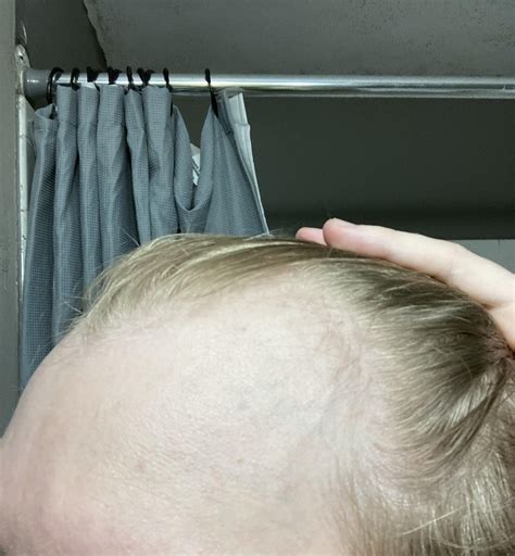 Finasteride Progress Pics August November March And Today Min For One Month R Tressless