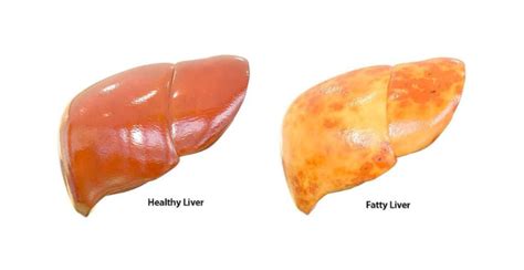 Fatty Liver Causes Symptoms Diagnosis Treatments And More