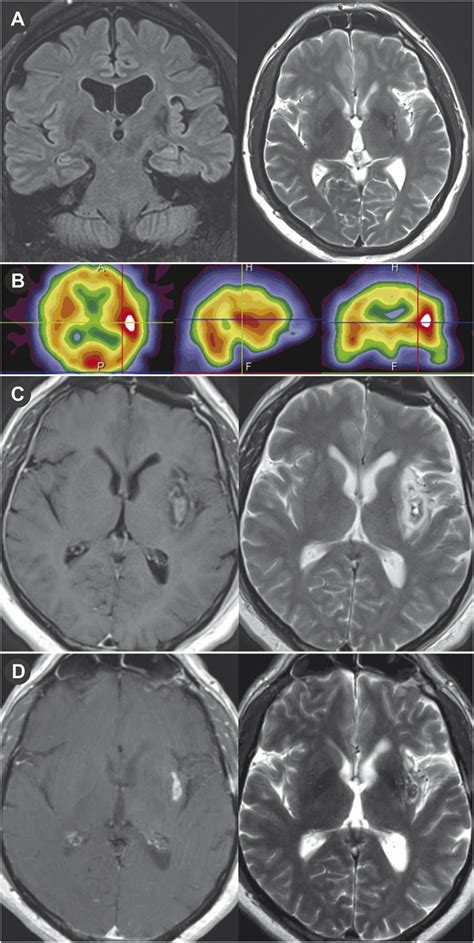 Magnetic Resonance Imaging Mri Showing Architectural Distortion In Download Scientific