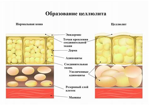 Как выглядит целлюлит на ляшках у женщин фото