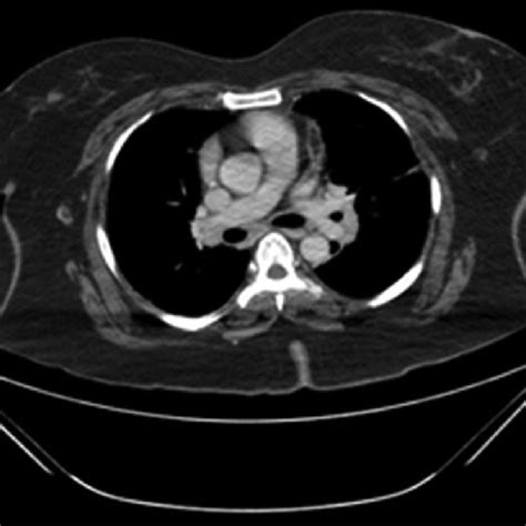 Gastroduodenoscopy Revealing Nodular Mucosa Download Scientific Diagram