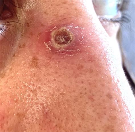 Possible Infected Pimples Rskin Possible Infected Pimples Rskin