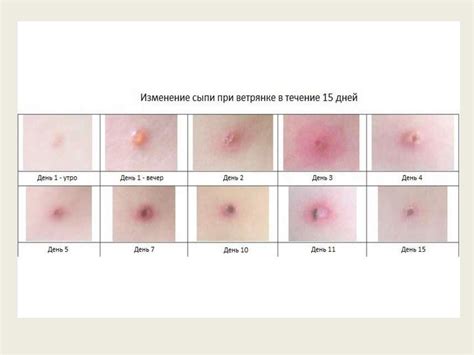 Инфекционные экзантемы презентация онлайн