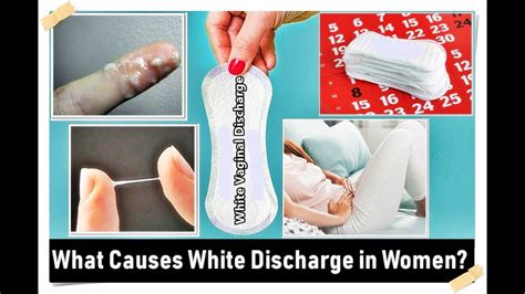 What Does It Mean By White Discharge At Genevieve Burns Blog