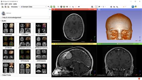 Sample Data 示例数据离线压缩包 2，来自 Caoyufu 软件数据 3dslicer中文论坛