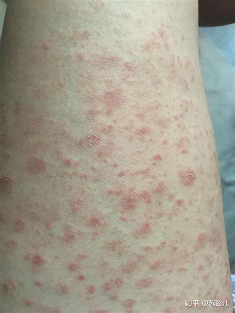 再也别见了玫瑰糠疹 知乎