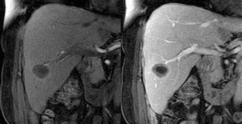 Liver Metastases Body Mri