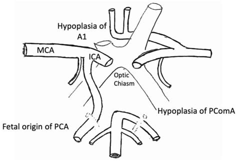 Anatomia Free Full Text Anatomy Of Cerebral Arteries With Clinical Aspects In Patients With