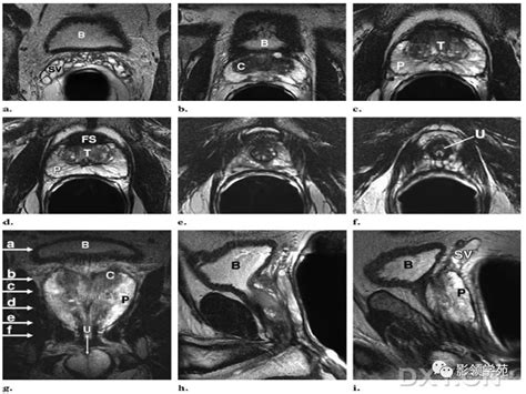 前列腺解剖及mri影像表现 医学界 助力医生临床决策和职业成长