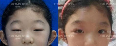 上眼睑下垂矫正矫正什么年龄段最佳？ 微医（挂号网）