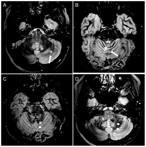 Cerebellar Intracortical And Leukocortical Lesions Axial Double